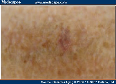 Nonmalignant Photodamage