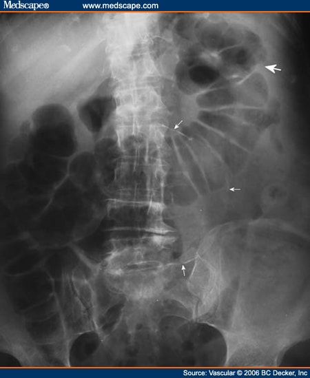 Synchronous Abdominal Aortic Aneurysm and Complicating Colorectal ...