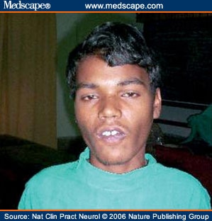 Wilson's Disease - Page 4