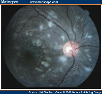 Recognition and Treatment of Retinal Manifestations of Systemic Vasculi ...