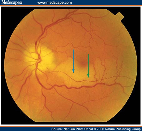 Recognition and Treatment of Retinal Manifestations of Systemic Vasculi ...