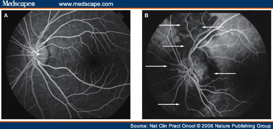 Recognition and Treatment of Retinal Manifestations of Systemic Vasculi ...