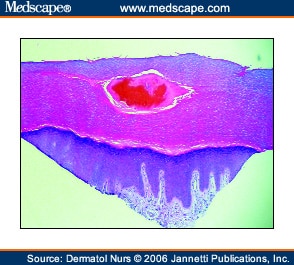 Intracorneal Hemorrhage