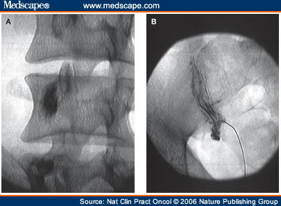 Technology Insight: Imaging of Low Back Pain - Page 3