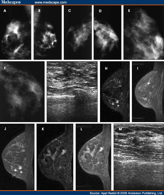 Ultrasound Tumors Under Armpit