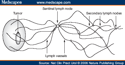 Radioguided Sentinel Lymph Node Dissection in Staging of Prostate ...
