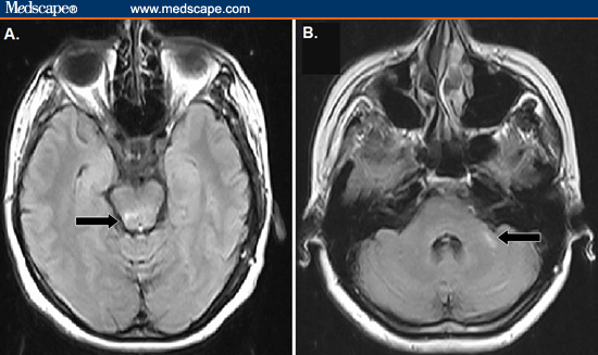 Brain-stem Listeriosis: SPECT vs MRI Findings - Page 2