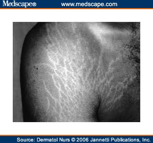 Case Study on Linear Focal Elastosis