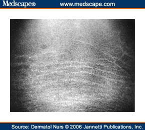 Case Study on Linear Focal Elastosis