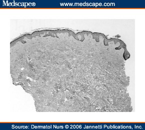 Case Study on Linear Focal Elastosis