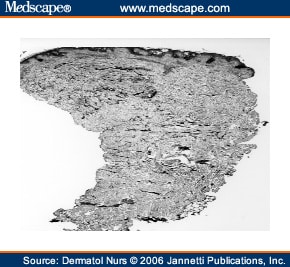 Case Study on Linear Focal Elastosis