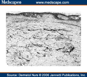 Case Study on Linear Focal Elastosis