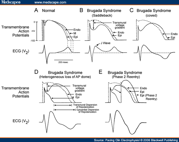 Brugada Syndrome - Page 3