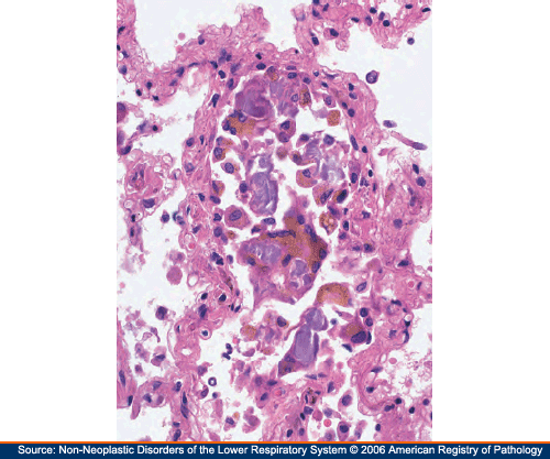 Handling and Analysis of Bronchoalveolar Lavage and Lung Biopsy ...