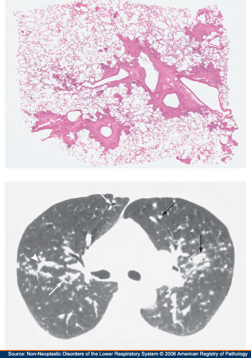 Handling and Analysis of Bronchoalveolar Lavage and Lung Biopsy ...
