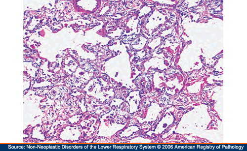 Handling and Analysis of Bronchoalveolar Lavage and Lung Biopsy ...