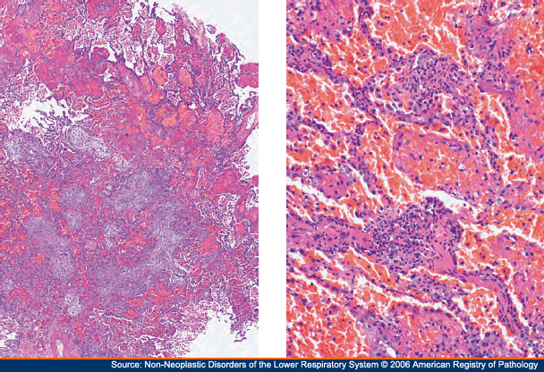 Handling and Analysis of Bronchoalveolar Lavage and Lung Biopsy ...