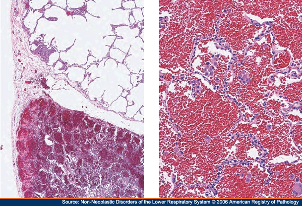 Handling and Analysis of Bronchoalveolar Lavage and Lung Biopsy ...