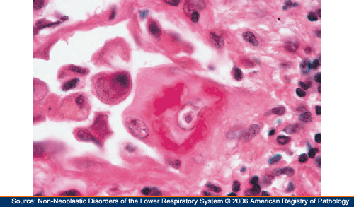 Handling and Analysis of Bronchoalveolar Lavage and Lung Biopsy ...