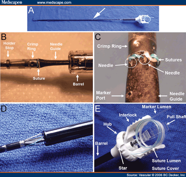 Percutaneous Thoracic and Abdominal Aortic Aneurysm Repair - Page 3