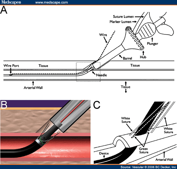 Percutaneous Thoracic and Abdominal Aortic Aneurysm Repair - Page 3