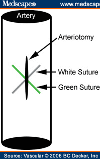 Percutaneous Thoracic and Abdominal Aortic Aneurysm Repair - Page 3