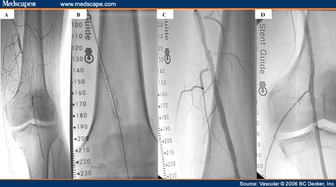 Cryoplasty in the Treatment of Infrainguinal Arterial Occlusive Disease ...