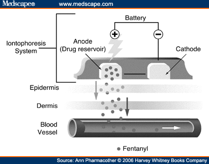 Fentanyl HCl Patient-Controlled Iontophoretic Transdermal System for ...