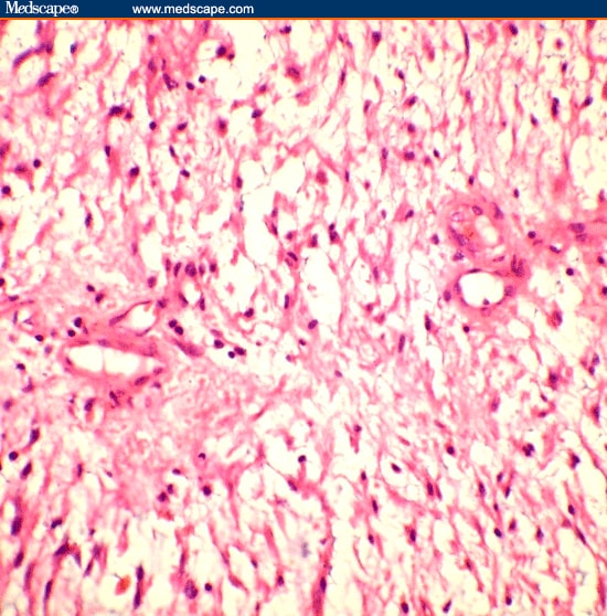 Aggressive Angiomyxoma of the Vulva in Pregnancy - Page 2