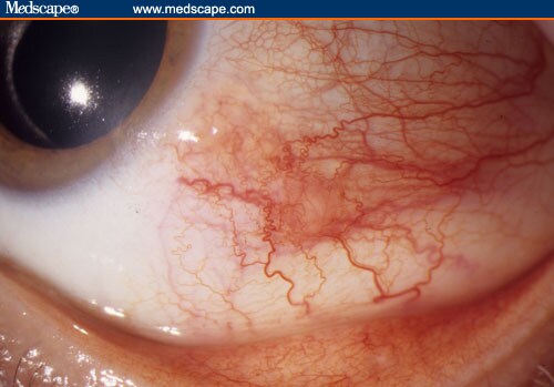 Extraintestinal Manifestations of IBD - Page 4