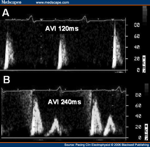Optimization of Device Programming for Cardiac Resynchronization ...