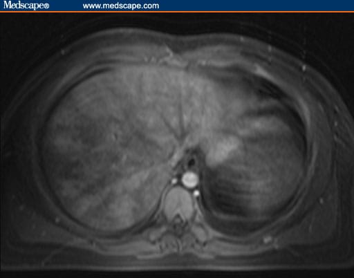 Acute Hepatic Dysfunction With Abdominal Pain and Ascites - Page 3