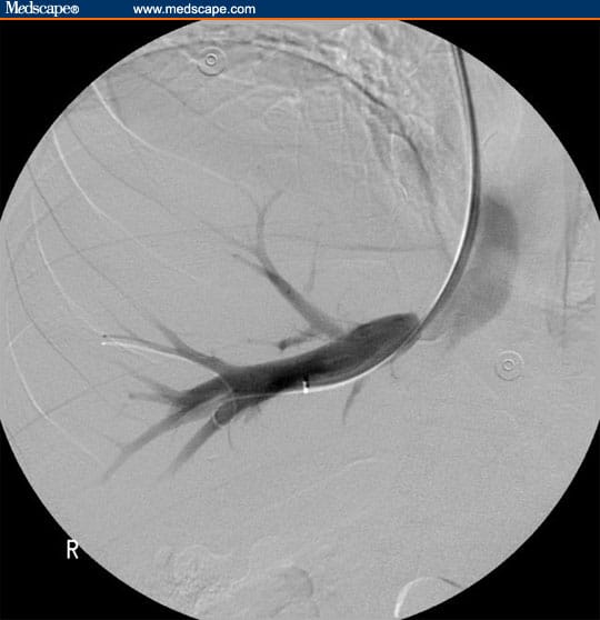 Acute Hepatic Dysfunction With Abdominal Pain and Ascites - Page 4