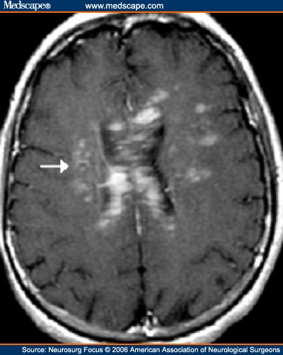 Primary CNS Lymphoma: Presentation, Diagnosis, and Staging