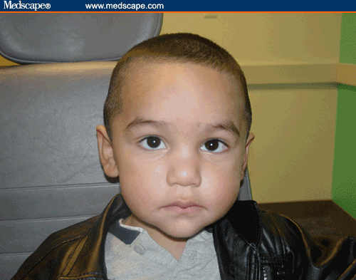 Acute-Onset Esotropia in a 2-Year-Old Boy