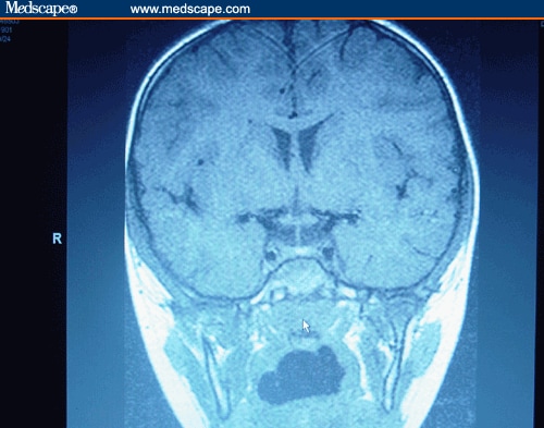 Acute-Onset Esotropia in a 2-Year-Old Boy