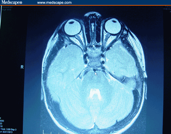Acute-Onset Esotropia in a 2-Year-Old Boy