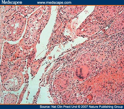 A Case of Scrotal Sarcoidosis that Mimicked Tuberculosis