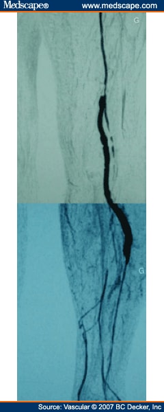 Simultaneous Ipsilateral Infrainguinal Angioplasty and Bypass ...