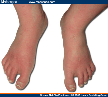 A Case of Inherited Erythromelalgia