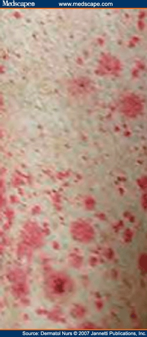Managing Cutaneous Vasculitis in a Patient With Lupus Erythematosus ...