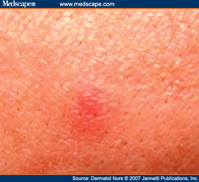 Managing Cutaneous Vasculitis in a Patient With Lupus Erythematosus ...