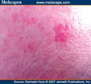Managing Cutaneous Vasculitis in a Patient With Lupus Erythematosus ...
