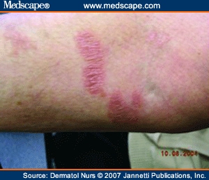 Photoresponsive Diseases - Page 3