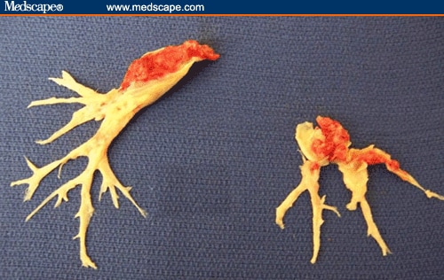 Chronic Thromboembolic Pulmonary Hypertension