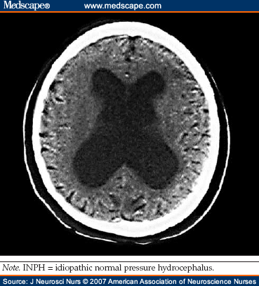 Diagnosis and Treatment of Idiopathic Normal Pressure Hydrocephalus