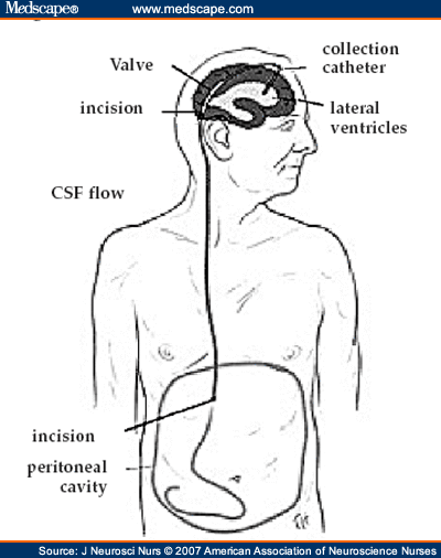 Diagnosis and Treatment of Idiopathic Normal Pressure Hydrocephalus ...