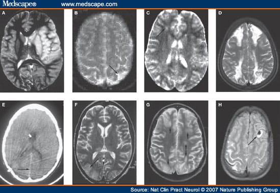 Stroke Risk and Its Management in Patients With Sickle Cell Disease ...