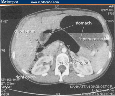 Severe Recurrent Abdominal Pain: Anatomical Variant of Chilaiditi Syndrome