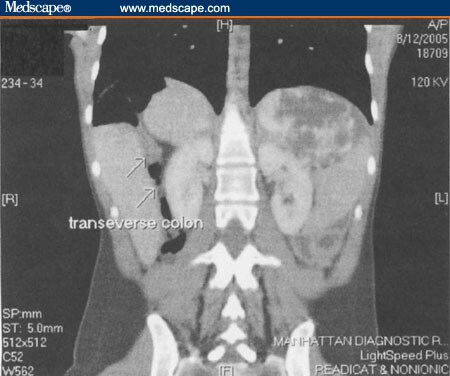 Severe Recurrent Abdominal Pain: Anatomical Variant of Chilaiditi Syndrome